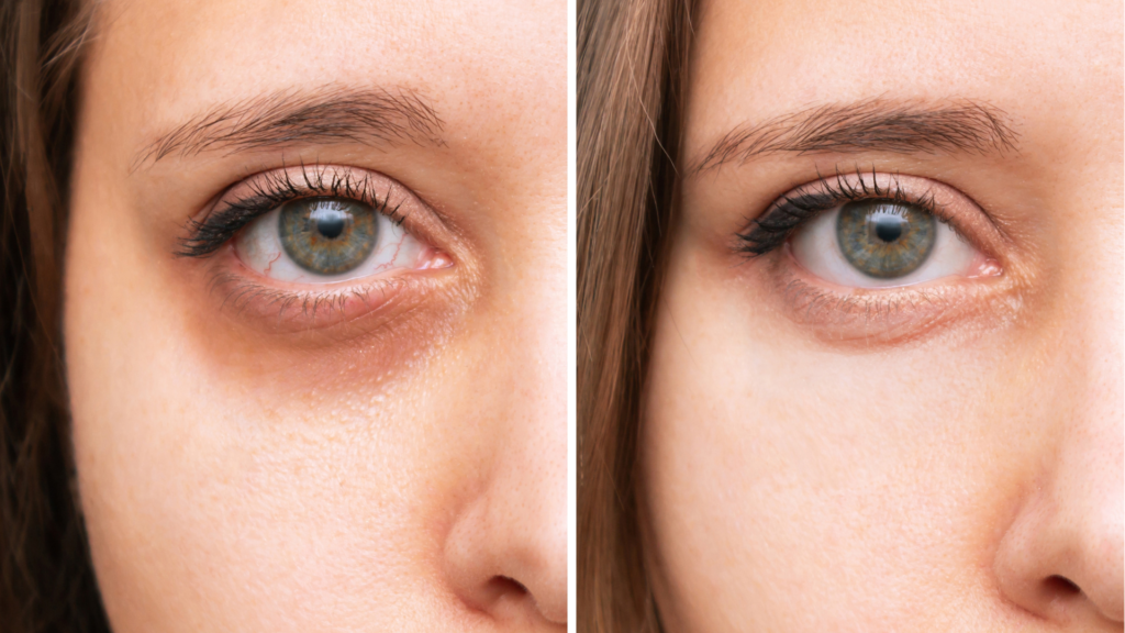 مزوژل جالپرو یانگ آی معجزه چشم ها | کلینیک زیبایی رز آبی